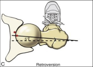 How Does Hip Anatomy Affect Your Mechanics?